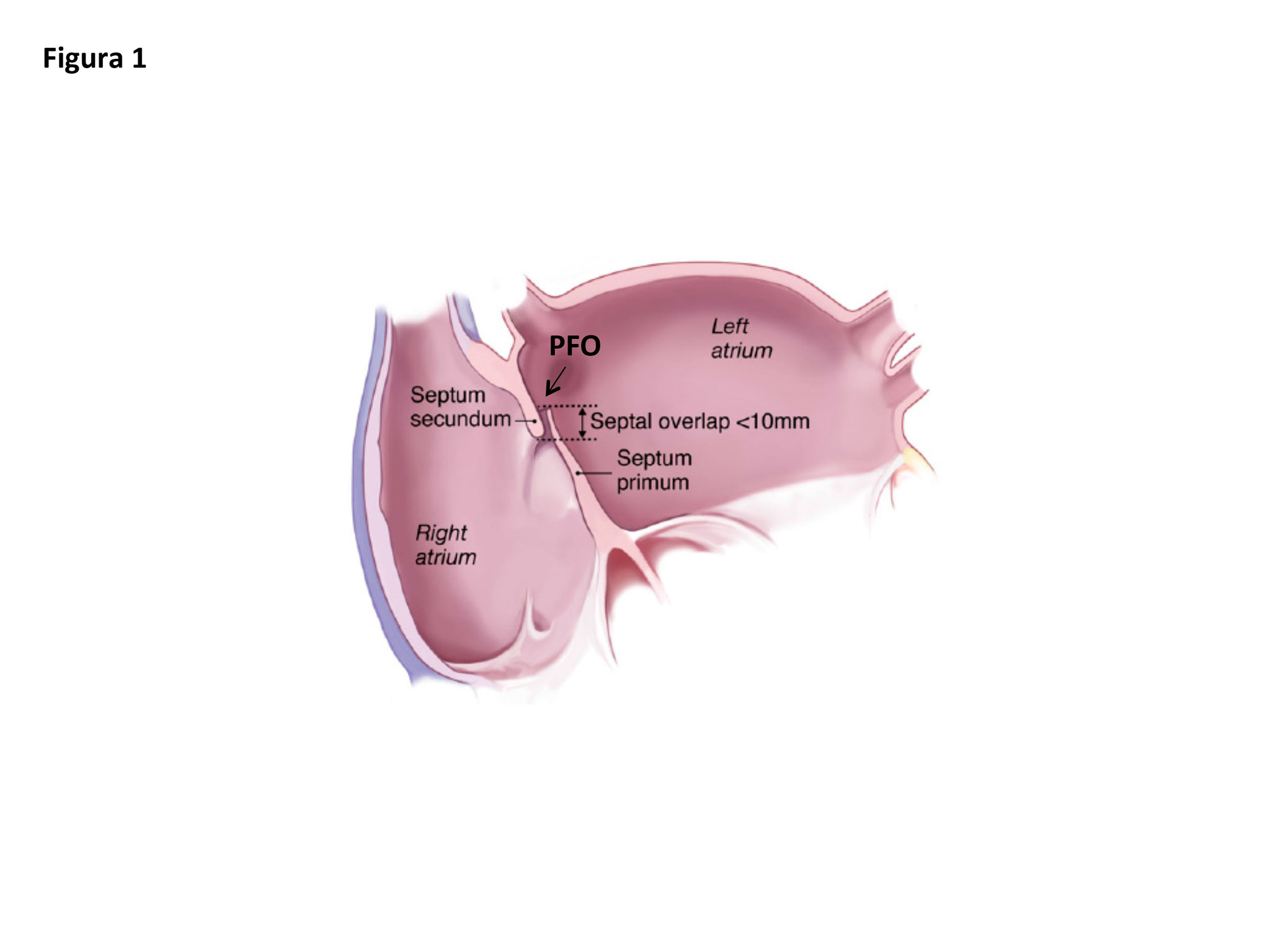 GASPARDONE E LA SUTURA DIRETTA. NobleStitch: TECNICA RIVOLUZIONARIA ...