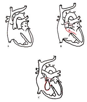 Transpositions des gros vaisseaux - Imagerie des malformations cardiaques