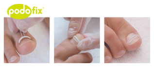 Ingroeiende teennagel behandeling - Medisch pedicure Zundert