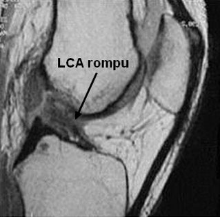 Lésions du ligament croisé antérieur - Dr. Zanone Xavier, Chirurgie ...