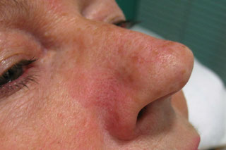 Facial Thread Vein treatment - Neath & Bridgend - Skin Clinic