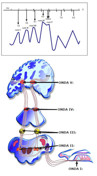 PEA, potenciales evocados auditivos - Centro Auditivo Cuenca, audífonos Valencia