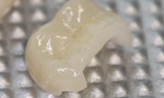 Teil - Kronen & Onlays schonen Zahnhartsubstanz - Zahnarzt Hauzenberg ...