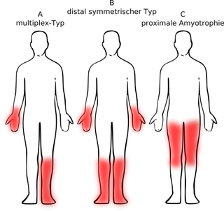 Capsaicin - Pflaster - Polyneuropathie Selbsthilfeforum