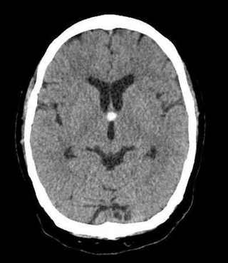 Colloid cyst - NeurologyNeeds.com