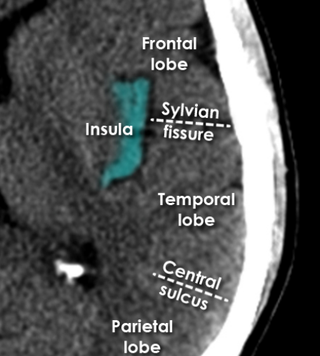 Brain CT - NeurologyNeeds.com