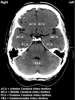 Brain CT - NeurologyNeeds.com