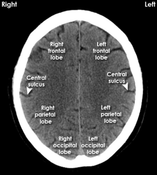 Brain CT - NeurologyNeeds.com