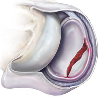 Schulterluxation = Ausrenkung der Schulter - ortho-clinics Webseite!