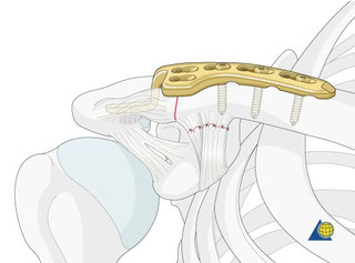 Schultereckgelenksprenung (AC-Luxation) - ortho-clinics Webseite!