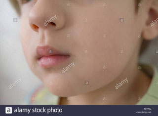 les cellulites cervico-faciales d'origine dentaire - Site de le-monde-d ...