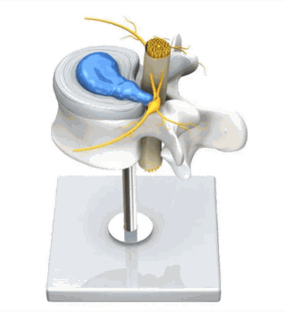 ESTENOSIS DE CANAL MEDULAR - ️ San Javier Fisioterapia