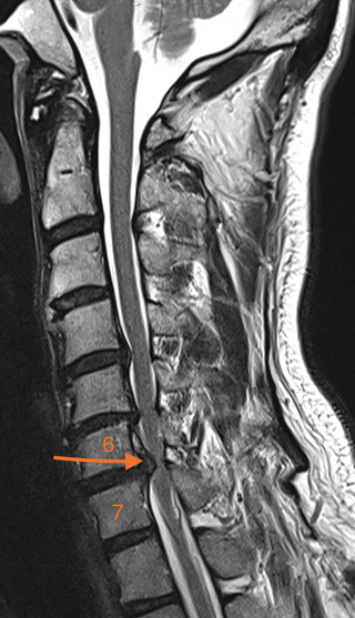 Zervikaler Bandscheibenvorfall - Neurochirurgie Wirbelsäulenchirurgie ...