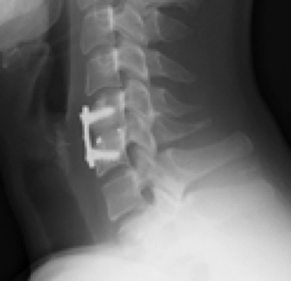 Hernie discale cervicale - Service d'Orthopédie du CHU de Reims