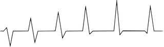 Achsenrotation - Fokus-EKG
