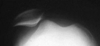 Instabilité rotulienne / Luxation de rotule - Dr. Zanone Xavier ...