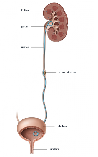 Calcolosi renale - Dr Carlo Negro - Urologo, andrologo