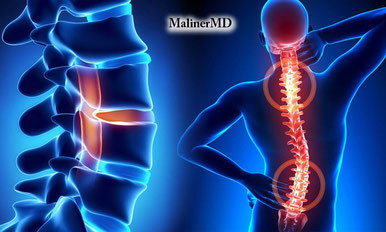 What Is The Treatment for Spinal Fracture? - malinermd