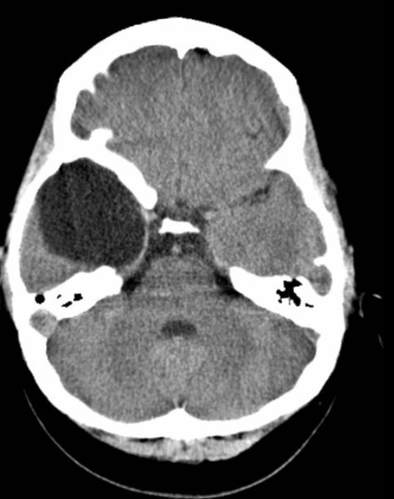 Arachnoid cyst - NeurologyNeeds.com