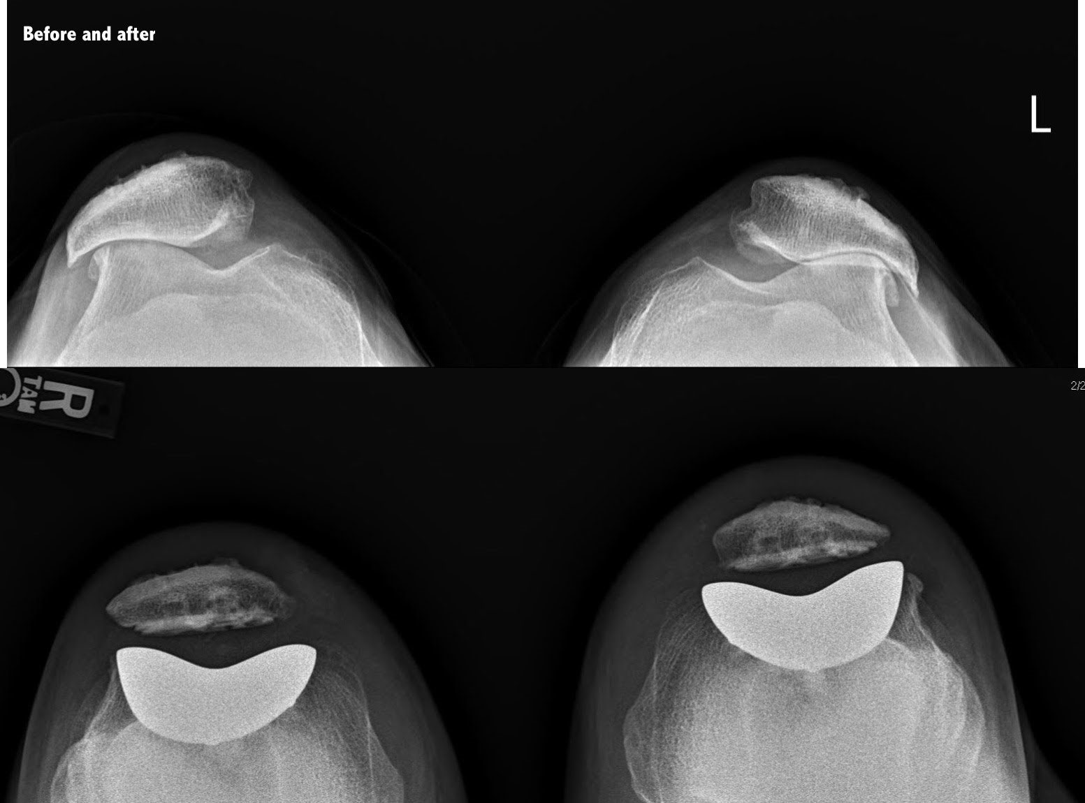 Clark's new knees - brockfolk