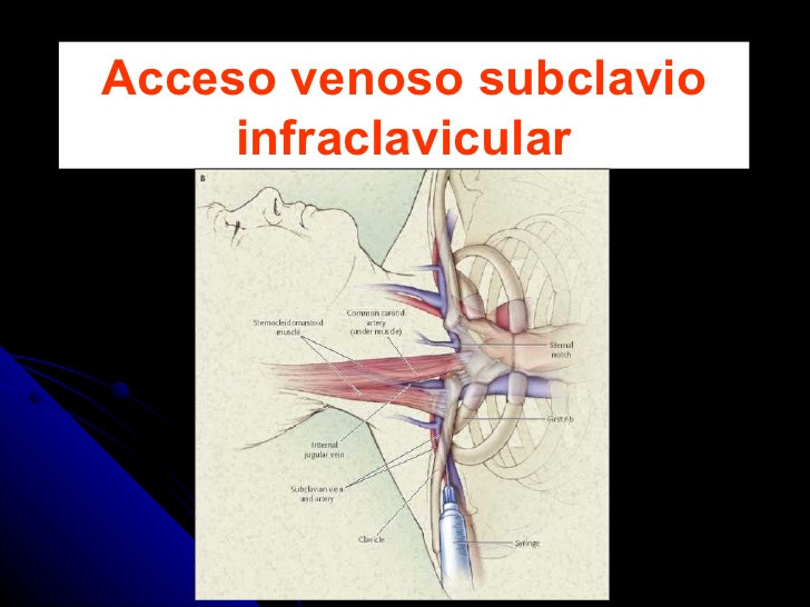 VÍDEO COLOCACIÓN DE CATÉTER VENOSO CENTRAL SUBCLAVIO - Nasajpg.com