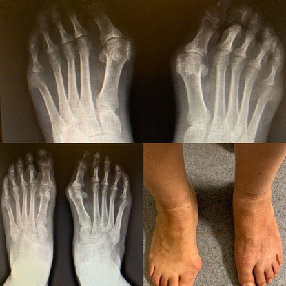 osteodesi, chirurgia dell'alluce valgo senza taglio dell'osso - Dr ...