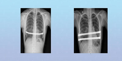 Delhi Thoracic Surgeon Doctors - pectusindia