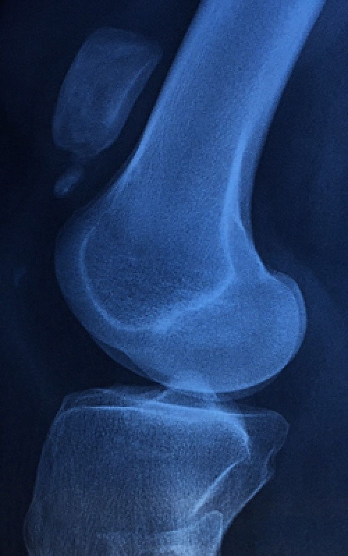 RÉ INSERTION DU TENDON ROTULIEN - Dr Rémi : chirurgien orthopédiste à ...