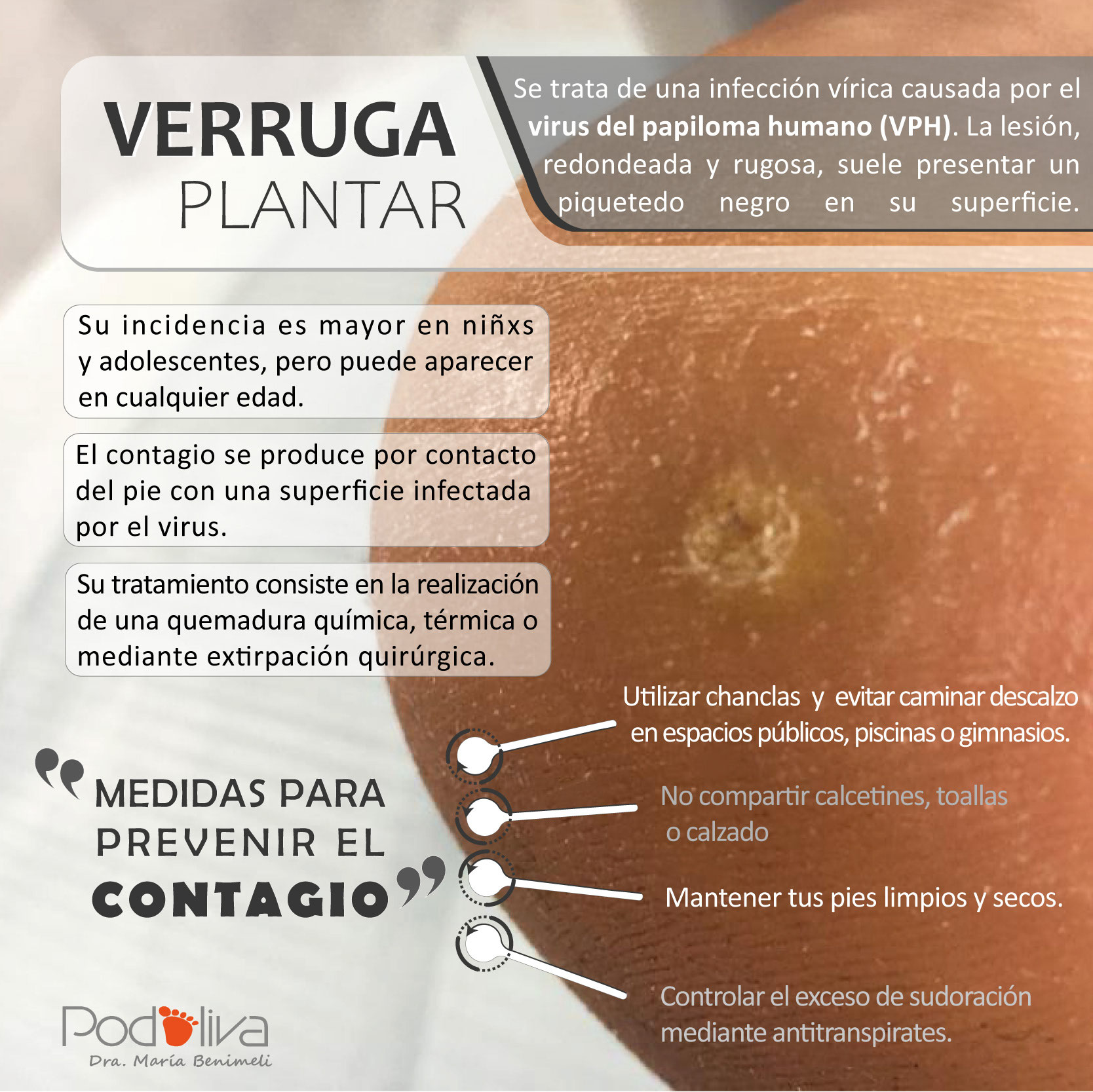VERRUGAS PLANTARES: QUÉ SON, POR QUÉ SE PRODUCEN Y CÓMO PREVENIRLAS ...