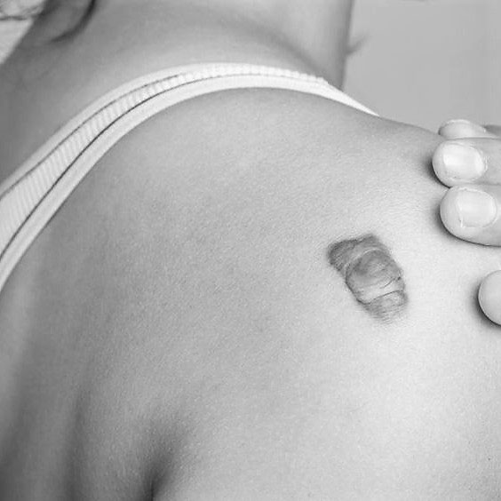 Hypertrophe Narben und Keloide nach chirurgischen Eingriffen - MEON ...