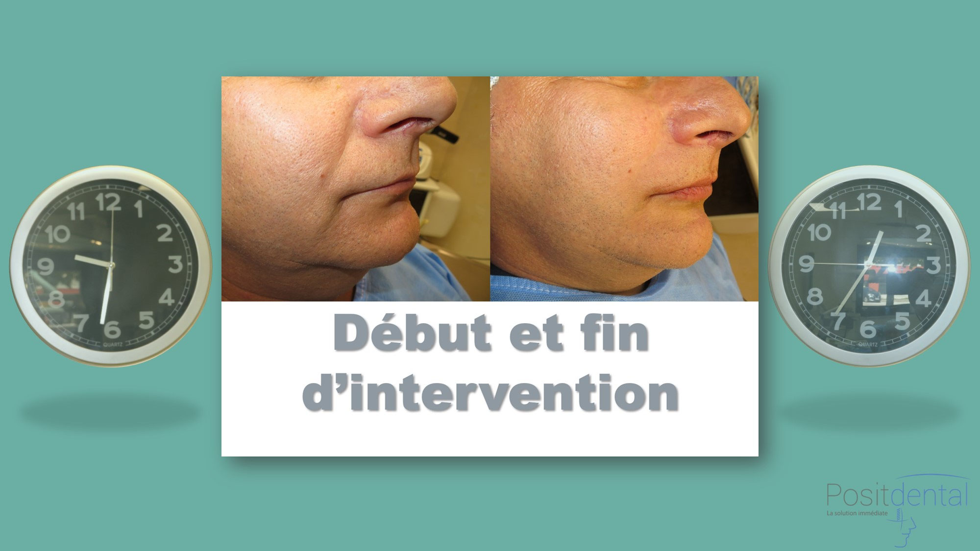 Compagnonnage en mise en charge en 1 seule intervention - chirurgie ...