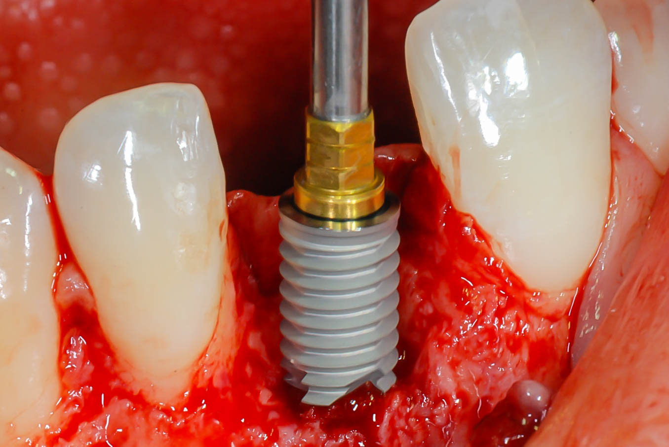 Implantate - Zahnarztpraxis Dr. Thalmair