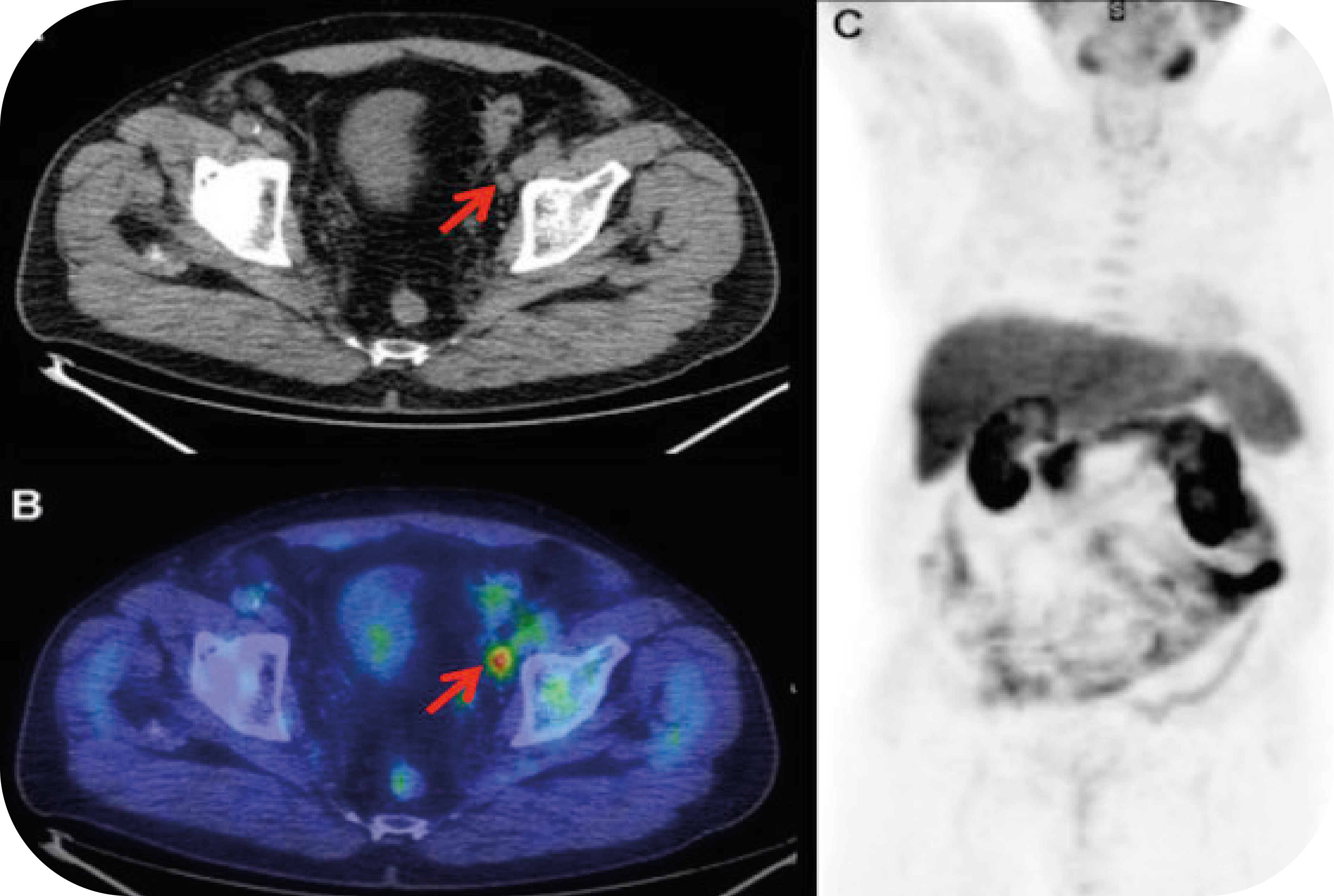 TC-PET PSMA e TC-PET colina: quali differenze nella diagnosi del carcinoma prostatico? - Dr ...