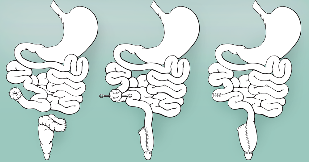 Home - ostomytheory