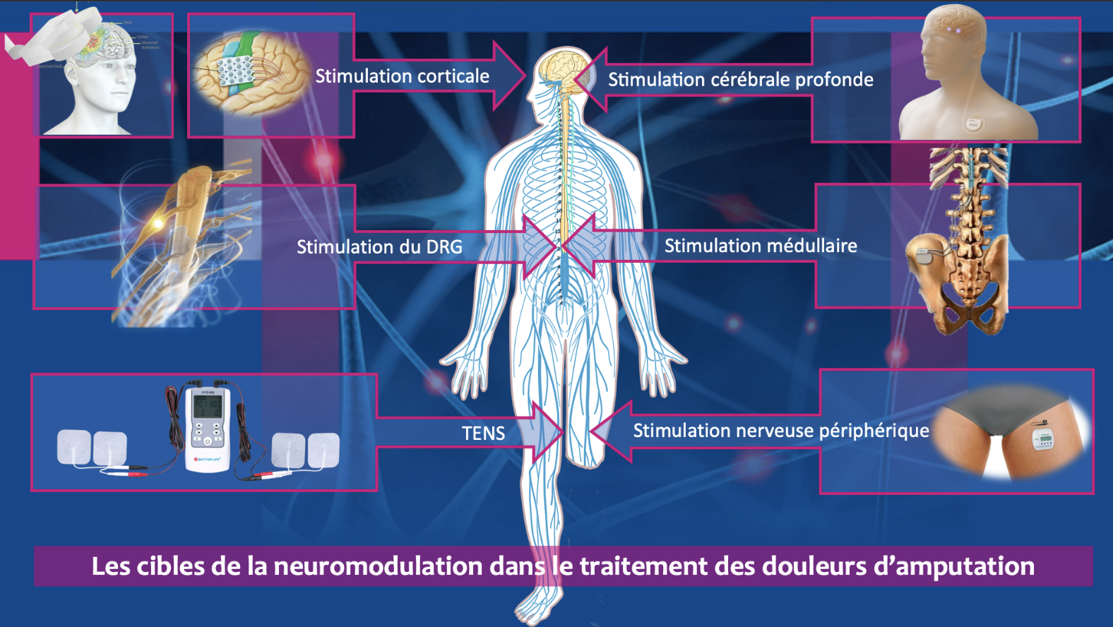 La neuromodulation dans les douleurs d'amputation - Neurochirurgien ...