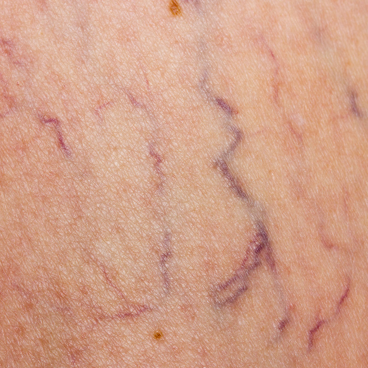 Lesiones Vasculares - Página web de lartesthetic