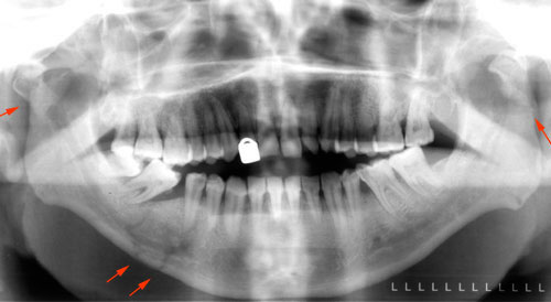 Caso 121 - FRACTURA MANDIBULAR - BICONDILAR - CDI