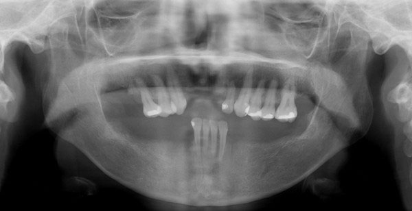 Caso 360 - LUXACIÓN DE ARTICULACIÓN TEMPOROMANDIBULAR - CDI