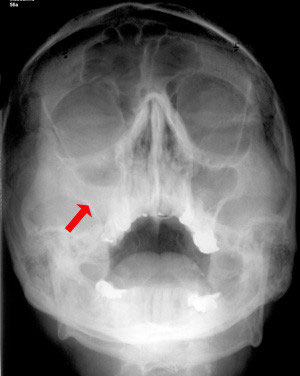 Caso 142 - SINUSITIS DEL MAXILAR - CDI