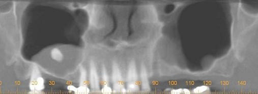 Caso 255 - CUERPO EXTRAÑO EN SENO MAXILAR (Evaluación con Tomografía ...