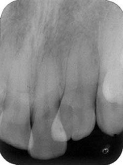 Caso 100 - GEMINACIÓN DENTARIA - CDI