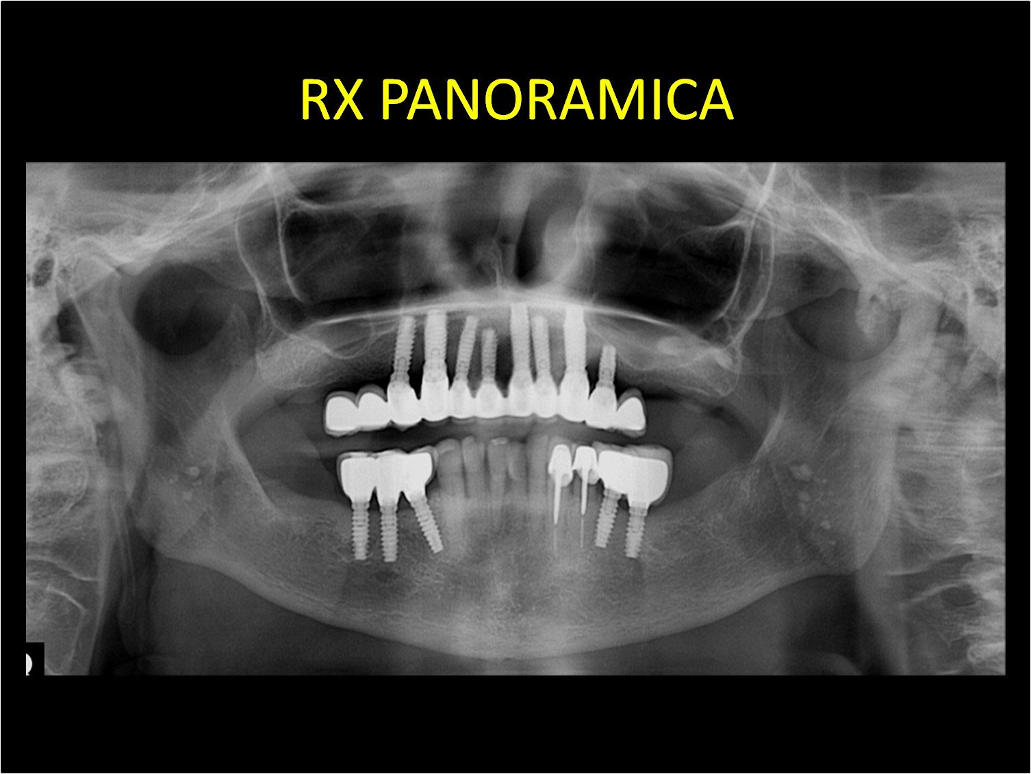 Caso N° 553 : Osteoartrosis de ATM - CDI