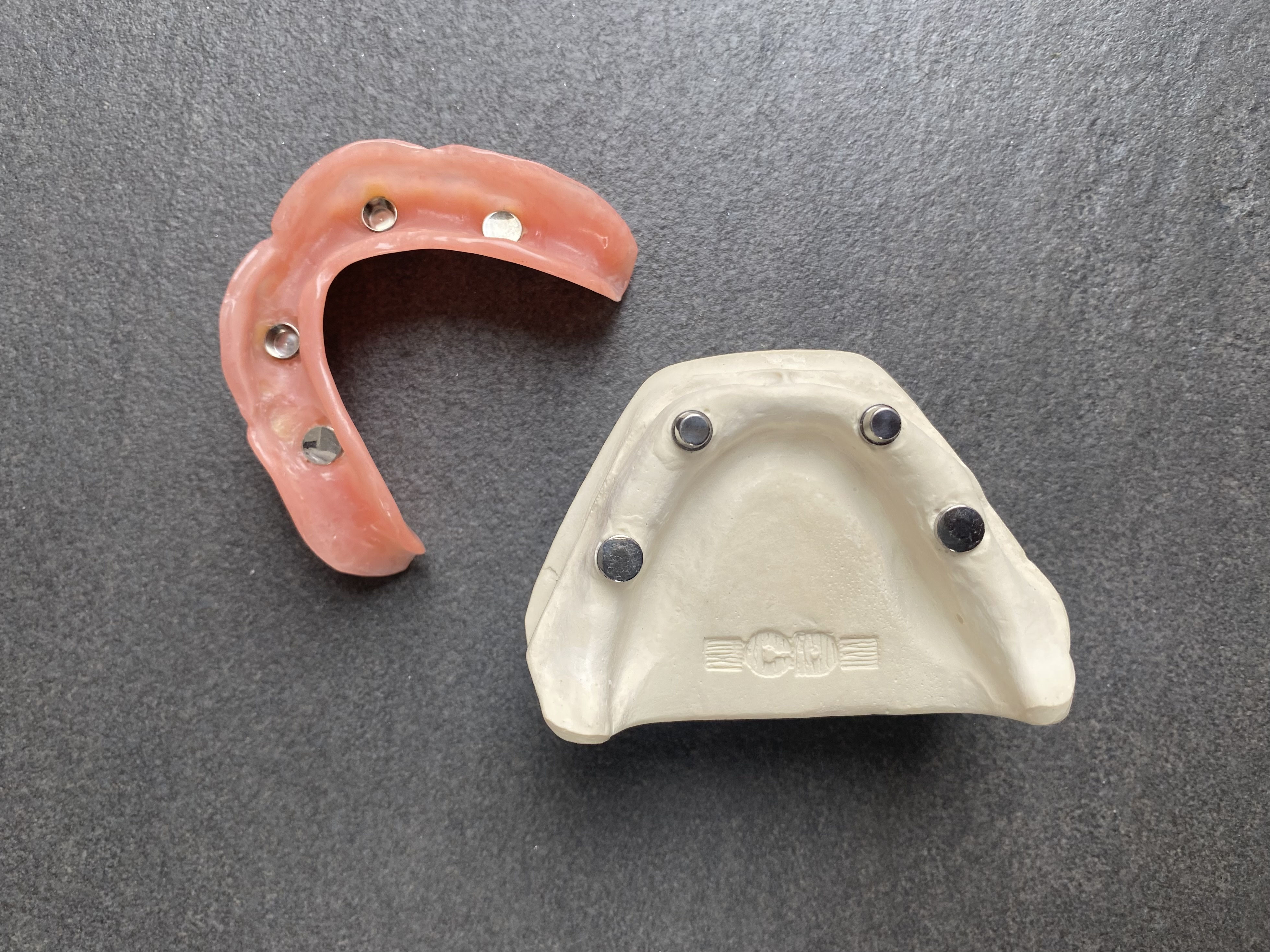 Kostengünstige Implantatlösung mit Preci Vertix© Geschiebe - Creativ ...