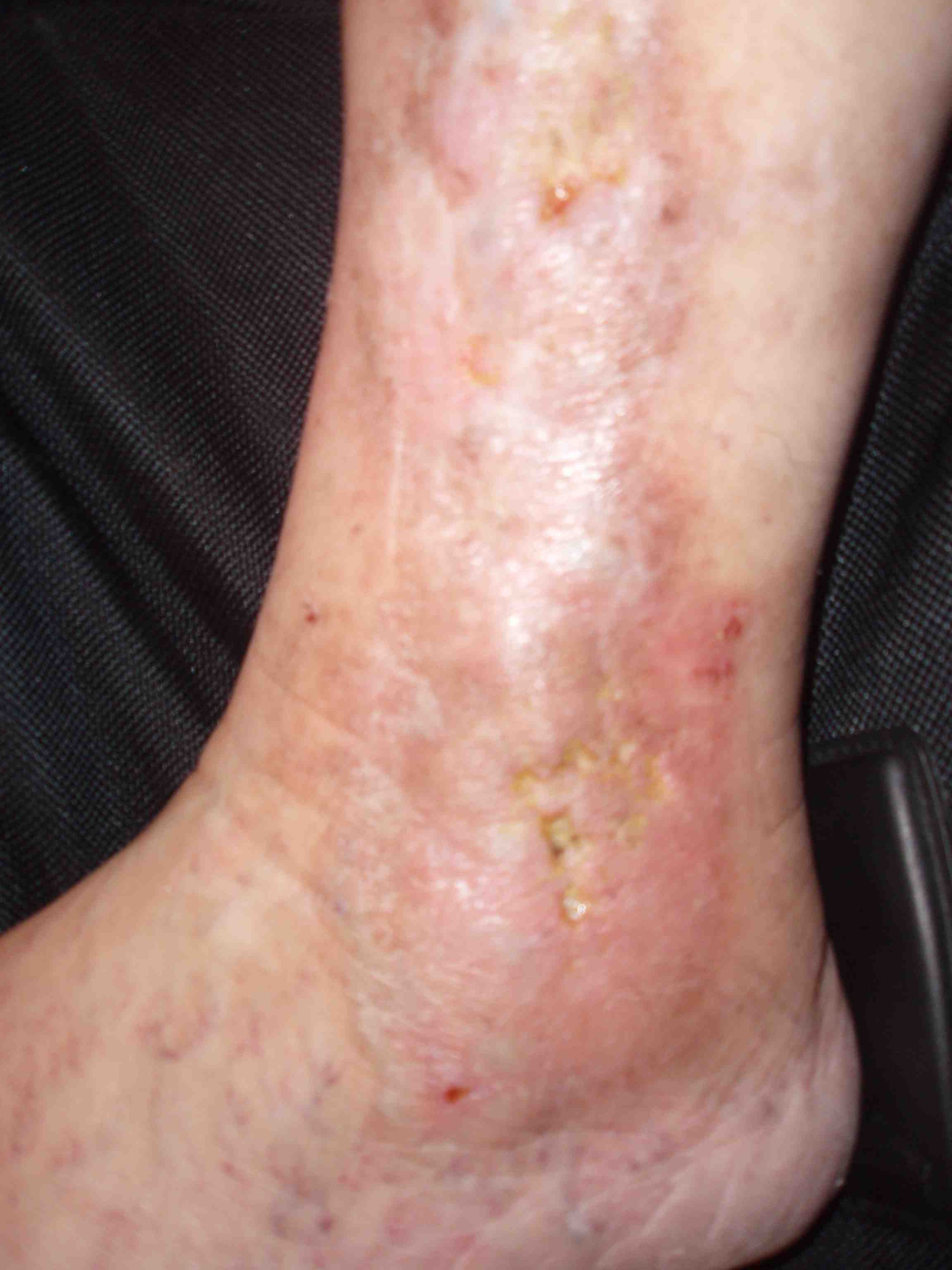 Úlceras en piernas - Página web de flebologiaylinfologialaplata