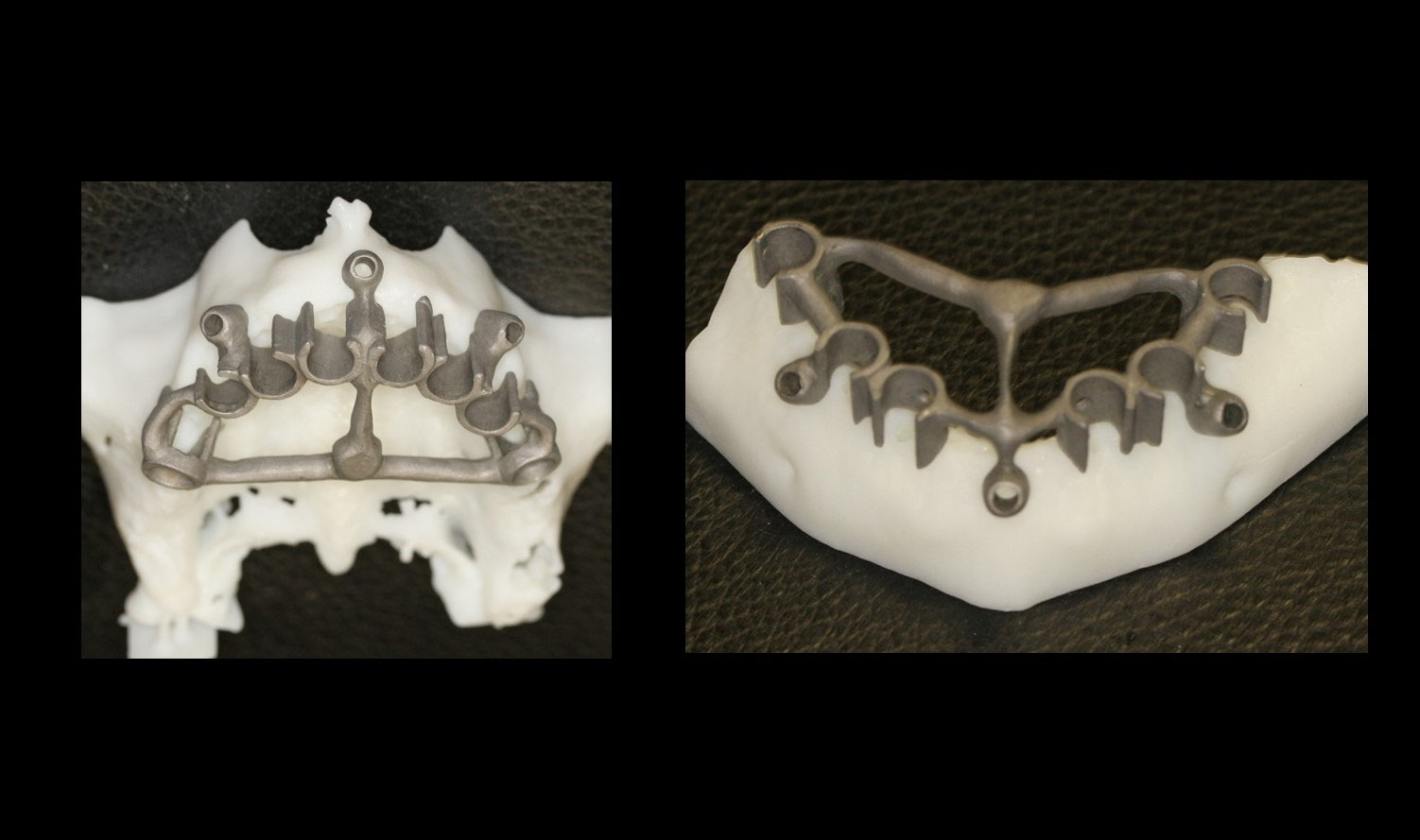 Chirurgie guidée implantaire - chirurgie guidée implantaire & guide ...