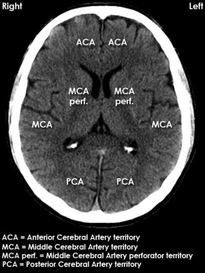 Brain CT - NeurologyNeeds.com