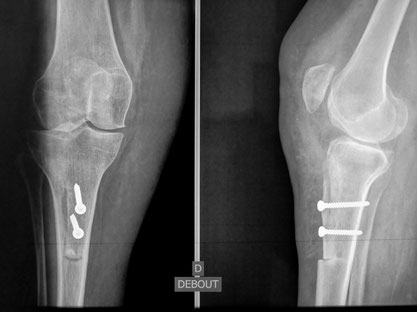 Instabilité rotulienne / Luxation de rotule - Dr. Zanone Xavier ...