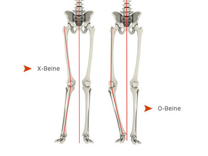 X- / O- Bein Fehlstellung - Orthopädische Ordination Dr. Florian Sevelda