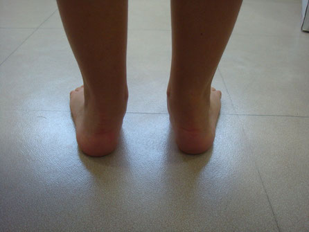 Les pathologies en podo-pédiatrie - Podologue Paris 7 BATTISTINI