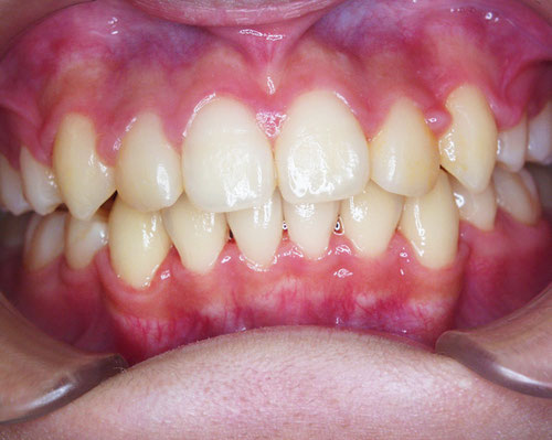 Your Tooth Type - CS Orthodontic Clinic | Shibuya Tokyo